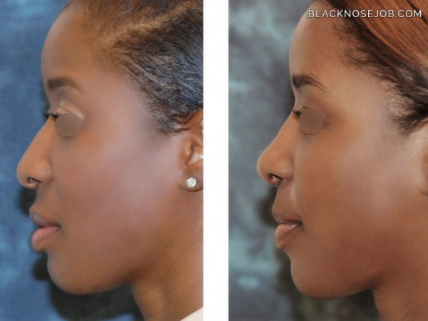 African American Rhinoplasty Specialist in Los Angeles, CA