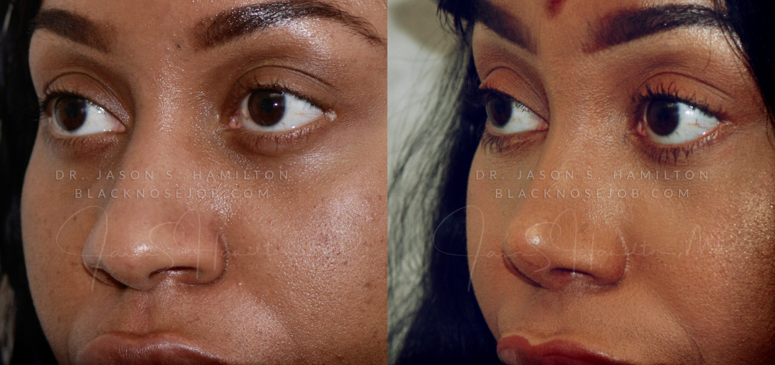 Ethnic Rhinoplasty Los Angeles Black Nose Surgery