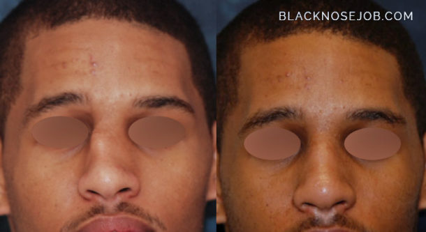 African American Rhinoplasty Specialist in Los Angeles, CA